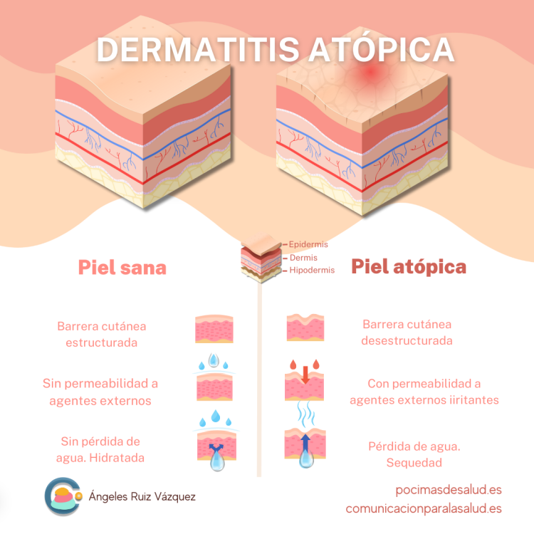 Dermatititis atópica: Causas, síntomas y tratamientos que debes conocer ...