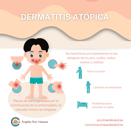 Dermatititis atópica: Causas, síntomas y tratamientos que debes conocer - Pocimas de salud